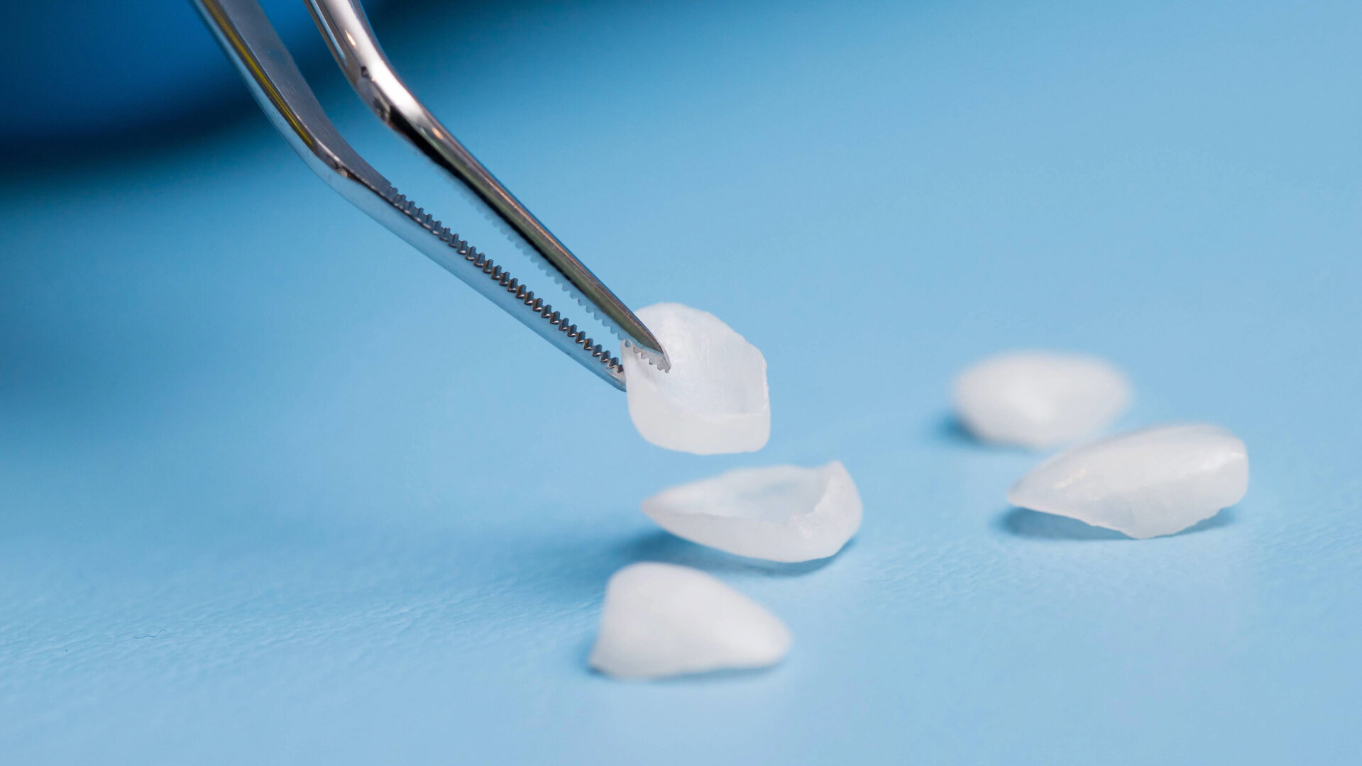 Six-year follow-up highlights durability of veneers