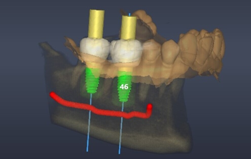 Immediate implant placement into two molar sockets