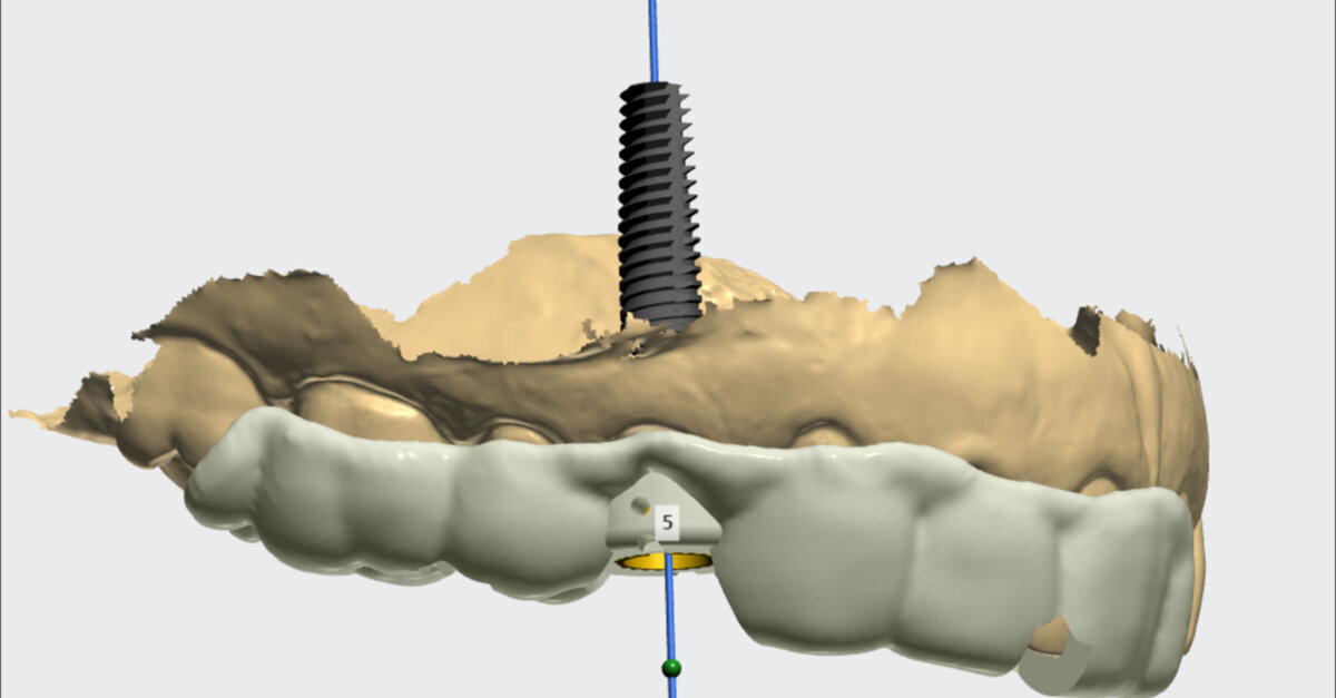 Clinical digital workflows for implant crowns