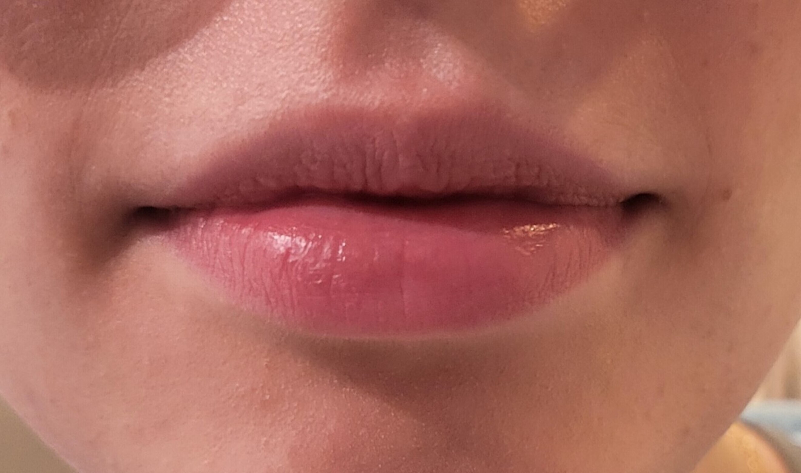 LipLase using the LightWalker Er:YAG laser