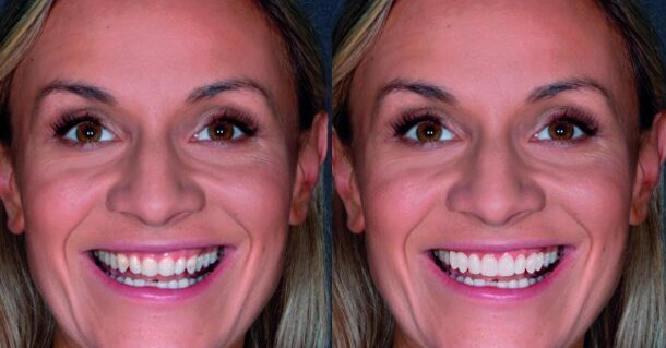 Dental News - Utilising smile design software and CAD/CAM for creating ...