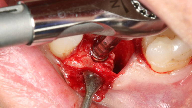 Dental News - Immediate implant placement and provisionalisation of a ...