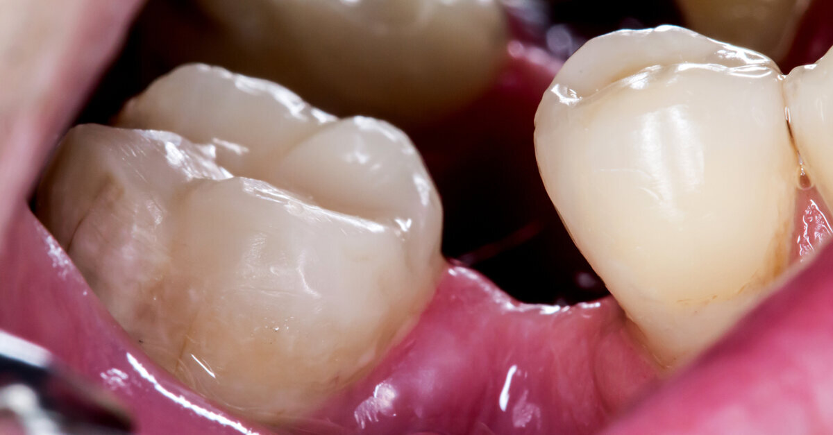 Growing new teeth: Will “every dentist’s dream" come true?