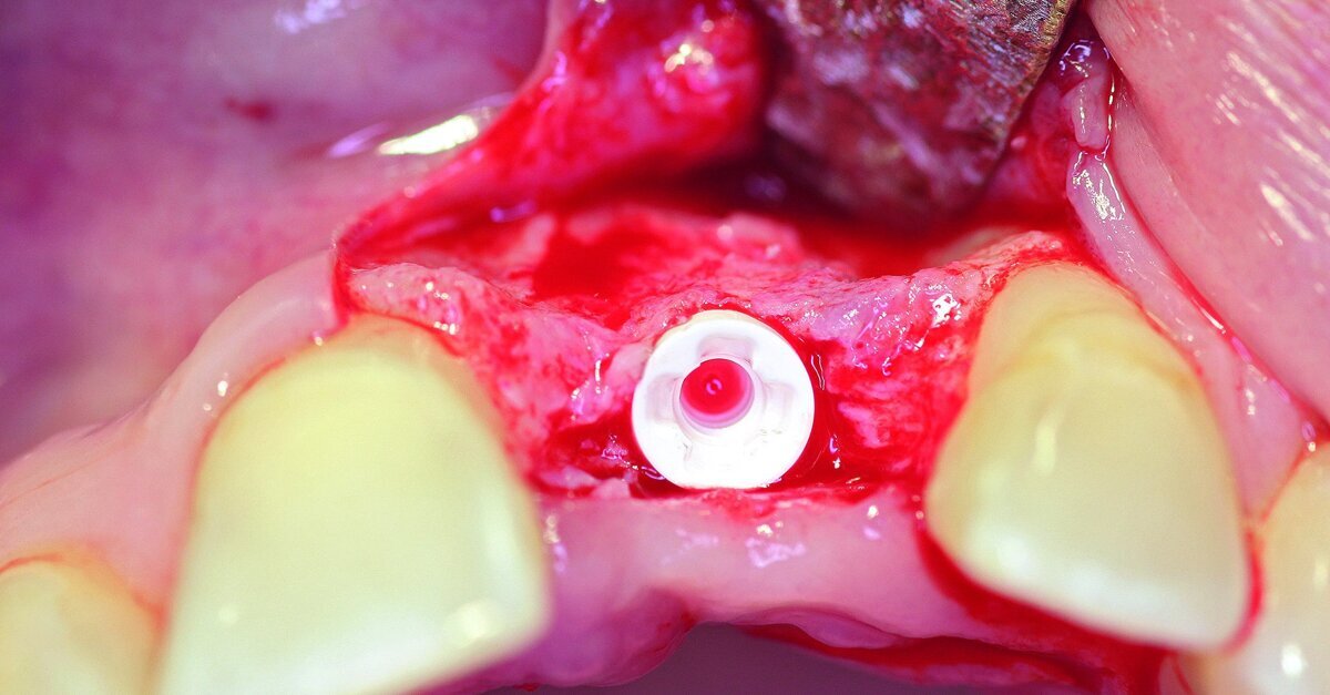Dental News - Single-tooth restoration using an all-ceramic implant ...