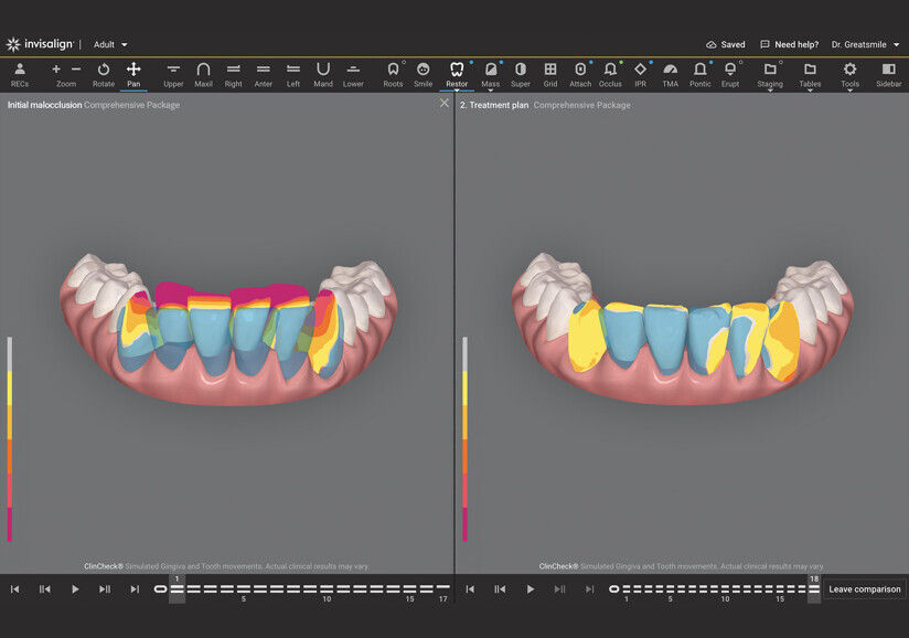 Invisalign Smile Architect Multi View