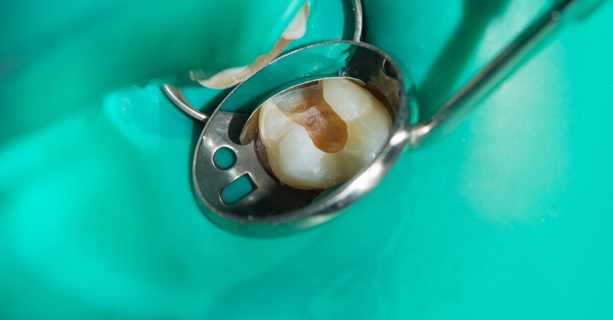 How to effectively use modern endodontic solutions