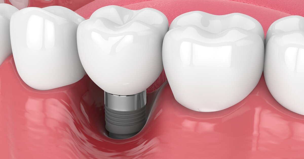 DT News - India - New research: understanding periodontal & peri ...