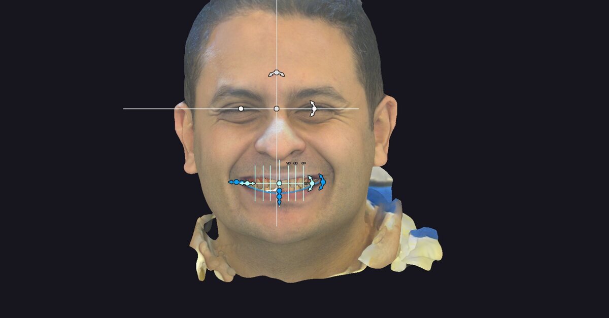 4D smile design with exocad Smile Creator software