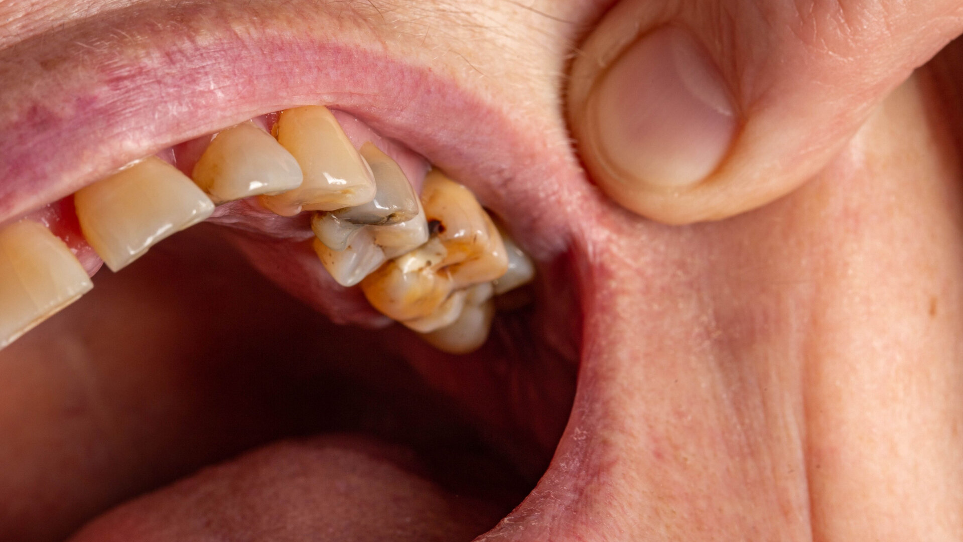 Dental News - New guide offers refresher on caries treatment and pulp ...