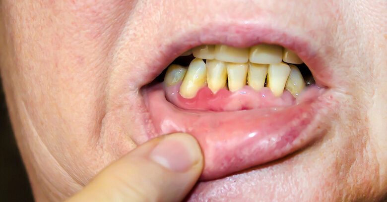 EFP and WHF release report on periodontal and heart health