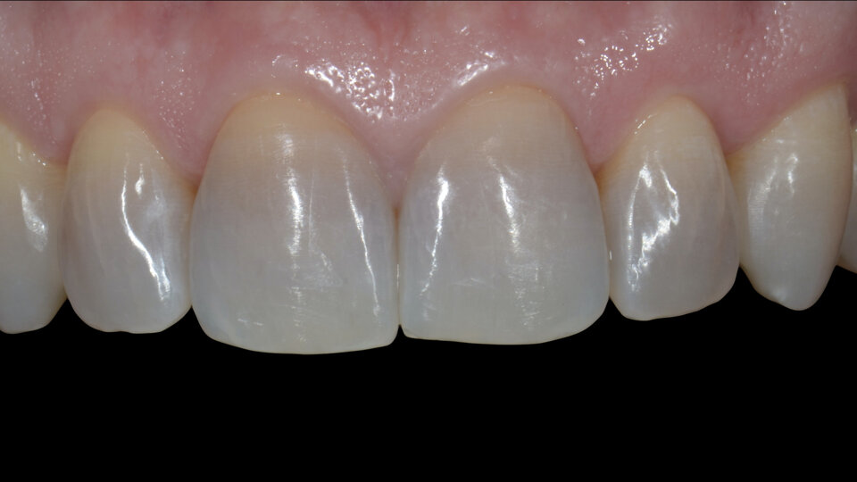 Aesthetic restoration of stained teeth with veneers