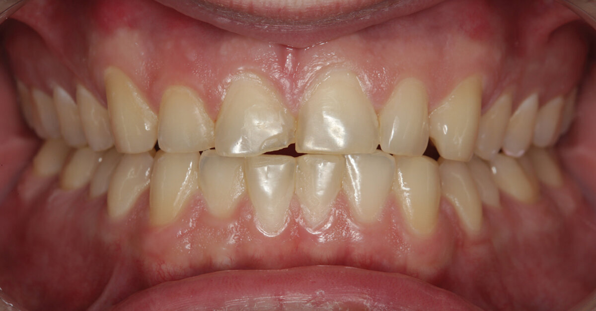 How occlusion can affect a single-tooth replacement