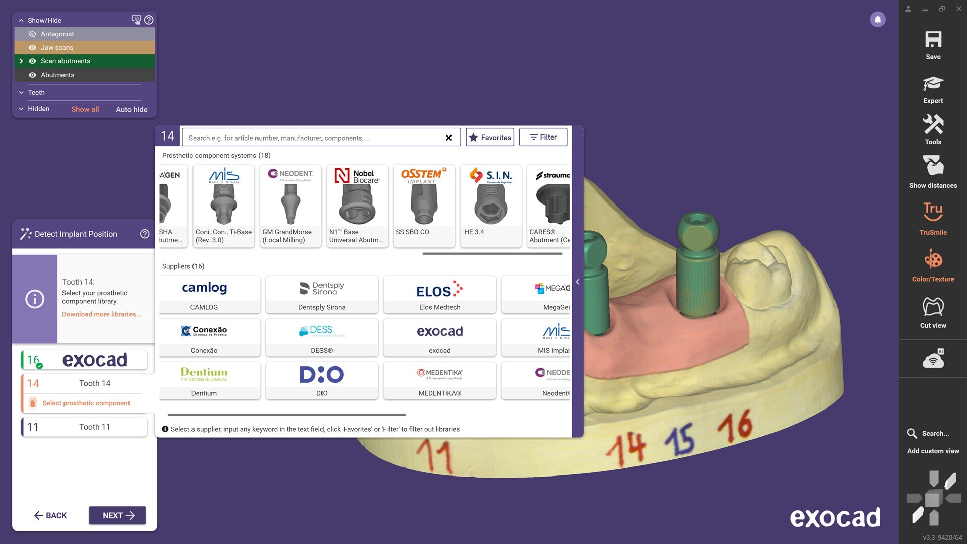 exocad DentalCAD 3.3 improves Implant Module workflow