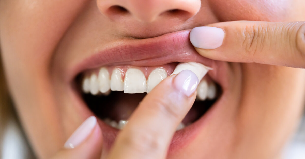 Snus linked to gingival damage but not periodontitis
