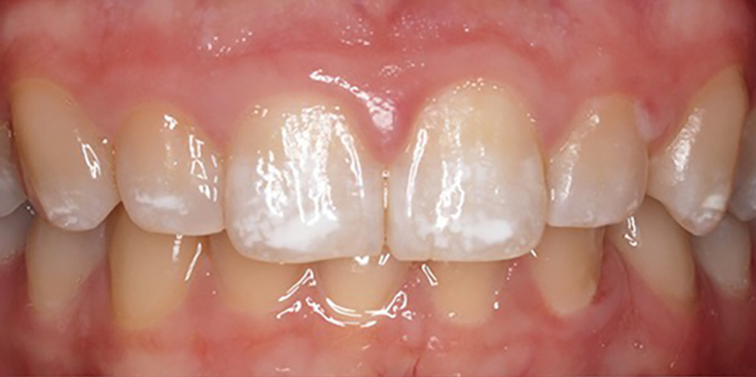 Dental News - Conservative aesthetic management of white spot fluorosis ...