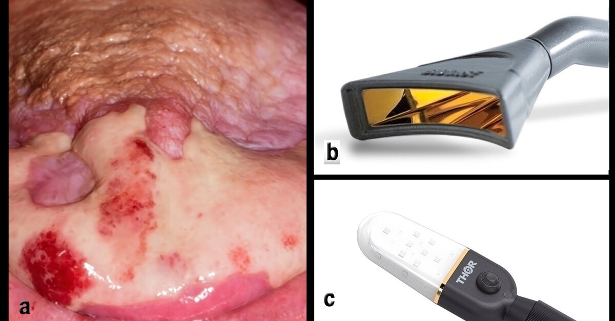 DT News - Spain - Fotobiomodulación para el tratamiento de la mucositis ...
