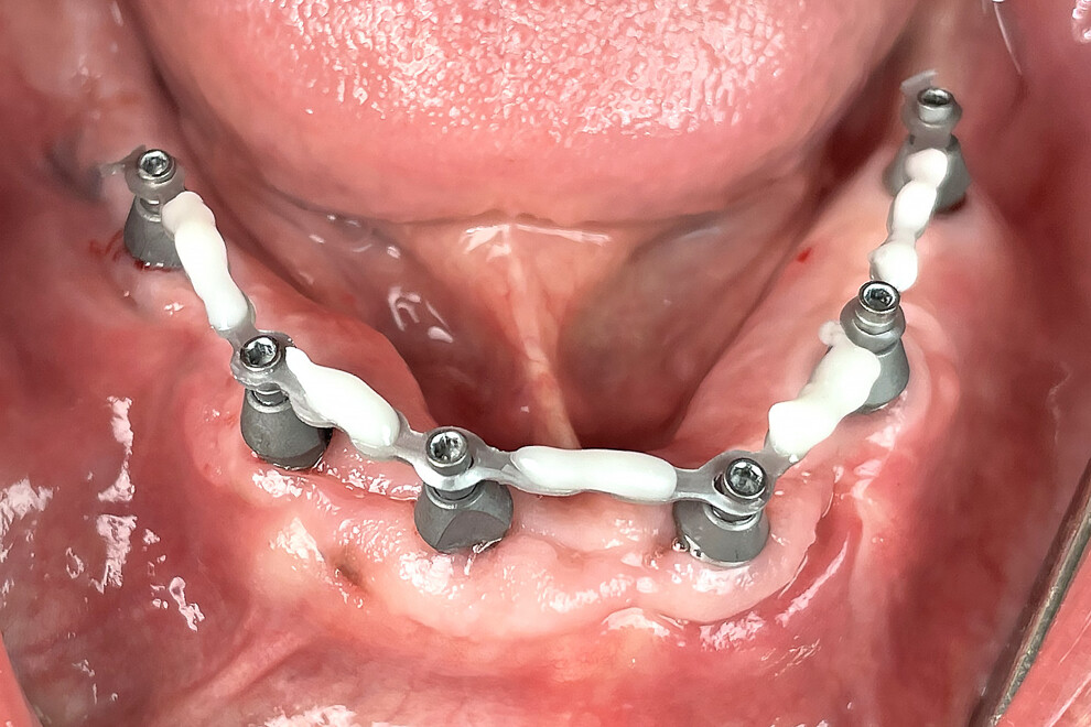 Continued advancements in full-arch implant restoration