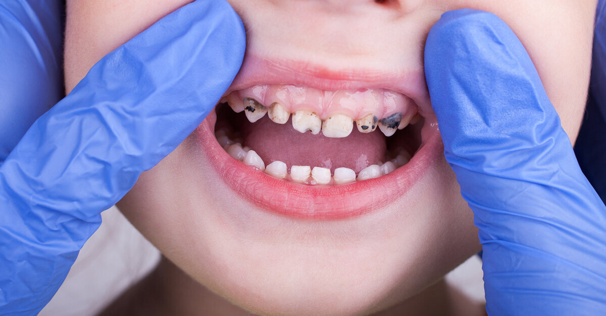 EFP reveals stunning global cost of dental caries