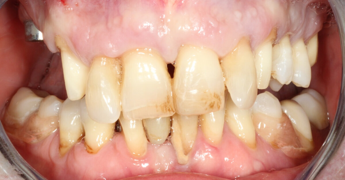 Dental News - Partial extraction therapy and implant treatment in the ...