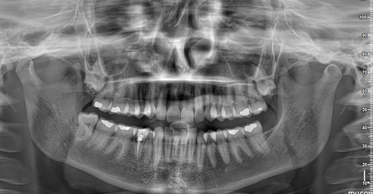 External cervical root resorption