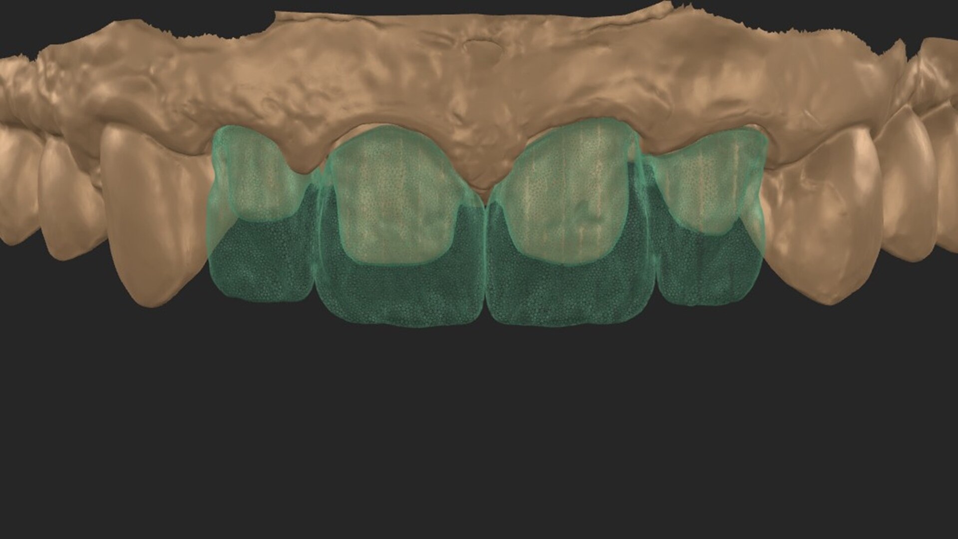 Micro-layering with CERABIEN MiLai