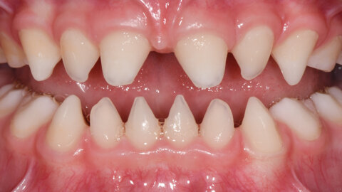 Dentsply Sirona introduces the CEREC Cercon 4D