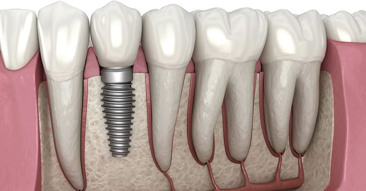 Dental News - Dental implants market strengthens as digital dentistry ...
