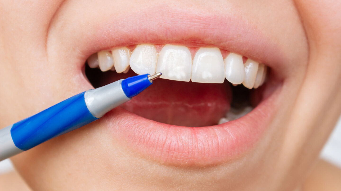 Dental News - Conservative aesthetic management of white spot fluorosis ...