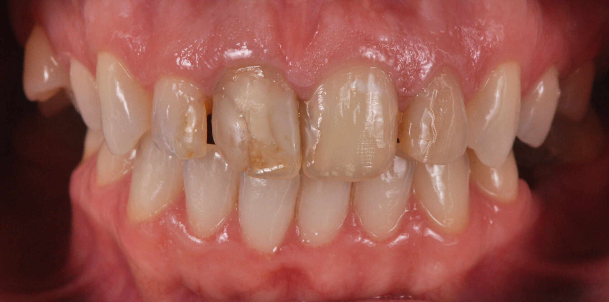 A hybrid technique for efficient and aesthetic restoration