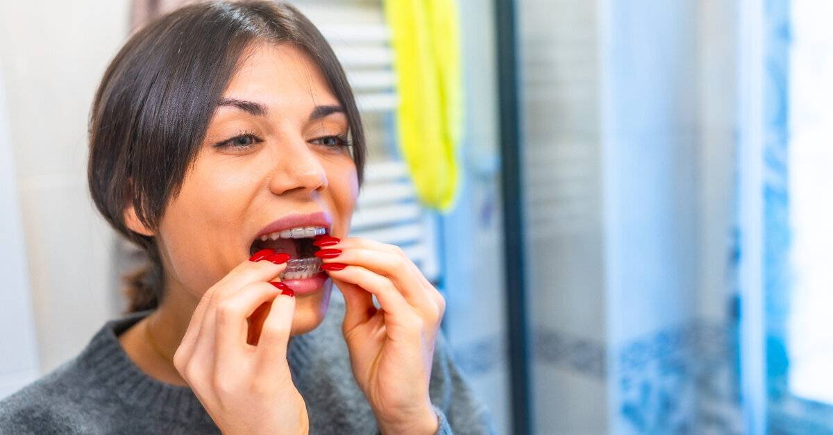 clear aligners: Aligning the future