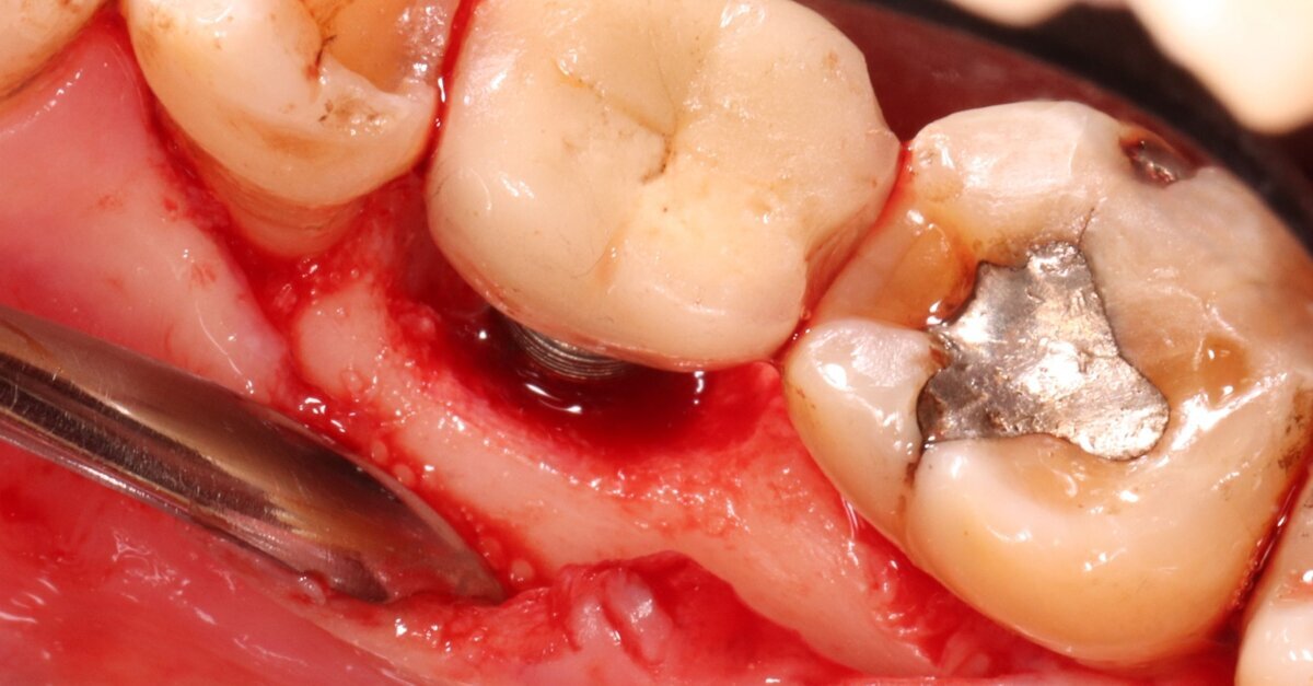 Citric acid seems an effective method of decontamination